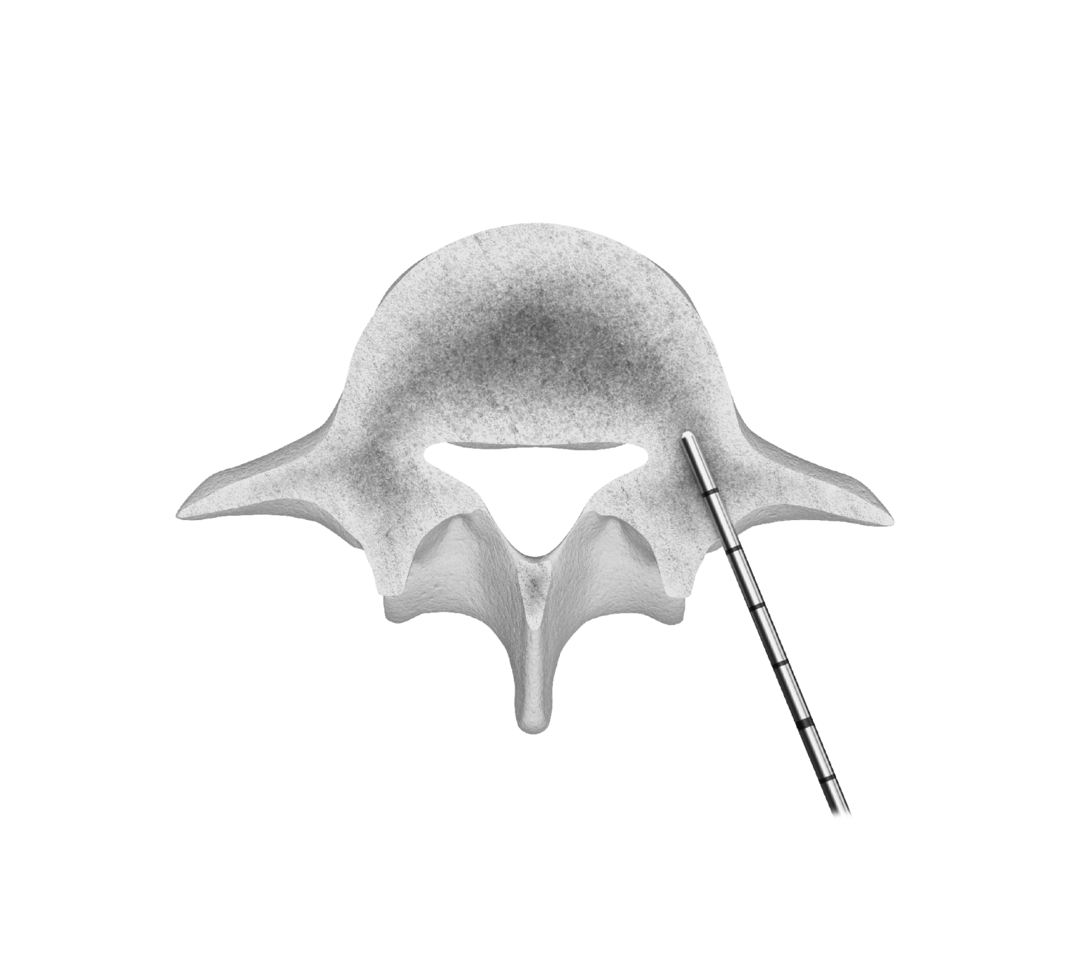 Innovative Products For Spine Surgery Minimally Invasive Methods