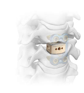 Cervical Spine fixation and interbody