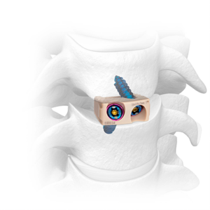 Cervical Spine fixation and interbody
