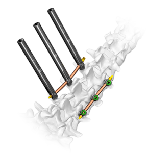 Spinal Fixation Devices Thoracolumbar Fixation Products