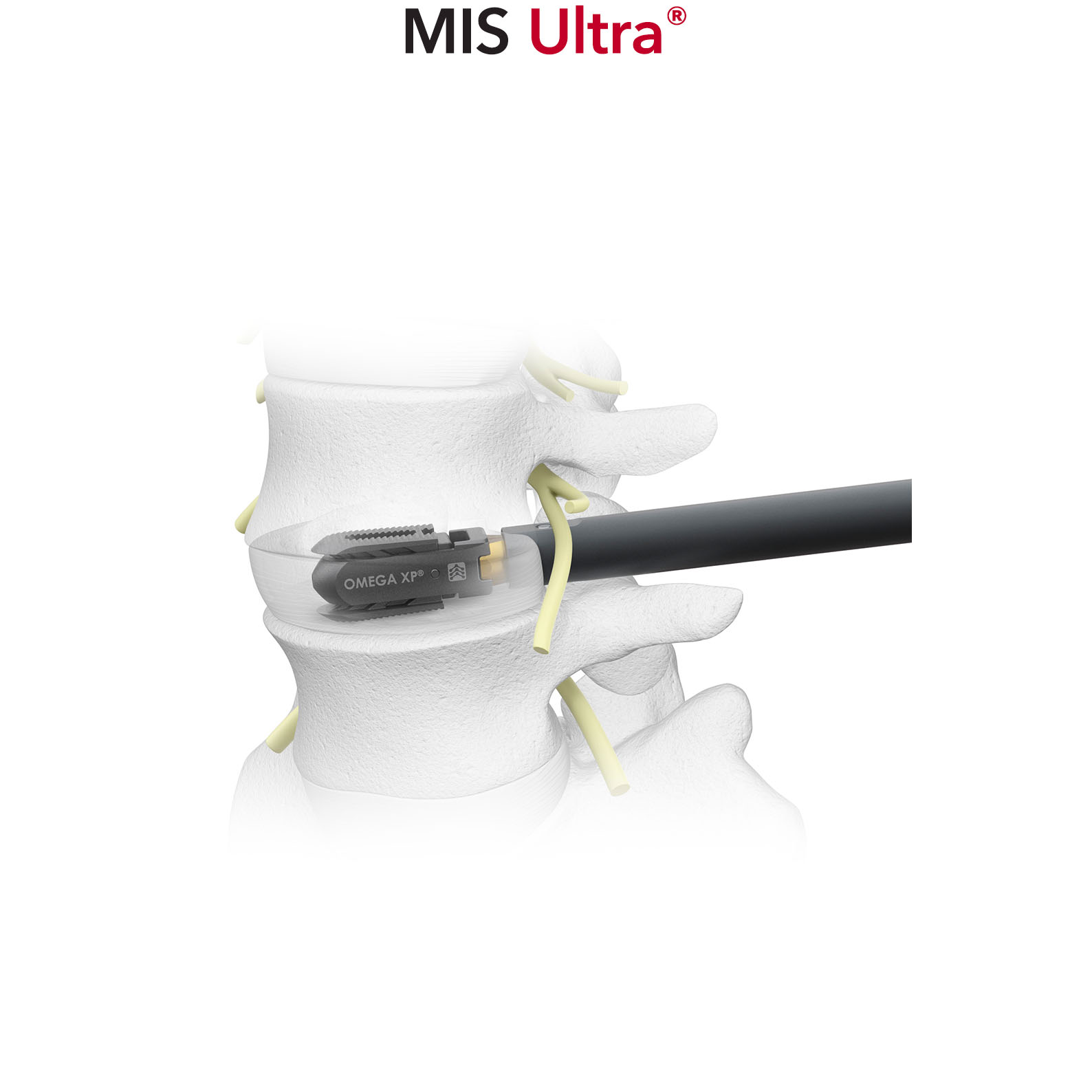 OmegaLIF® (EX/EF) Solutions For Spinal Surgery