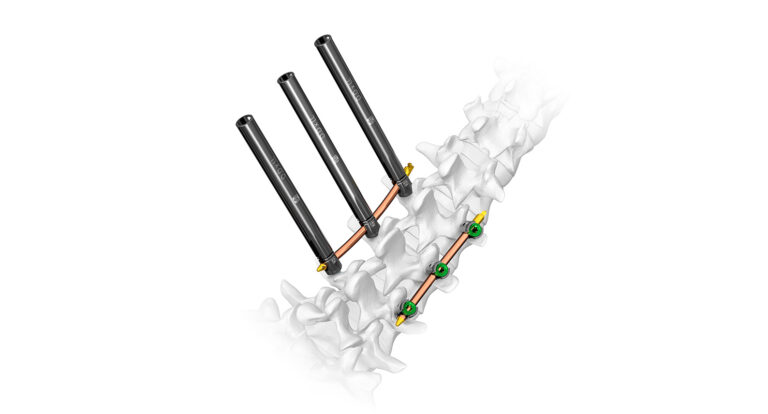 MIS Ultra® - Spinal Elements