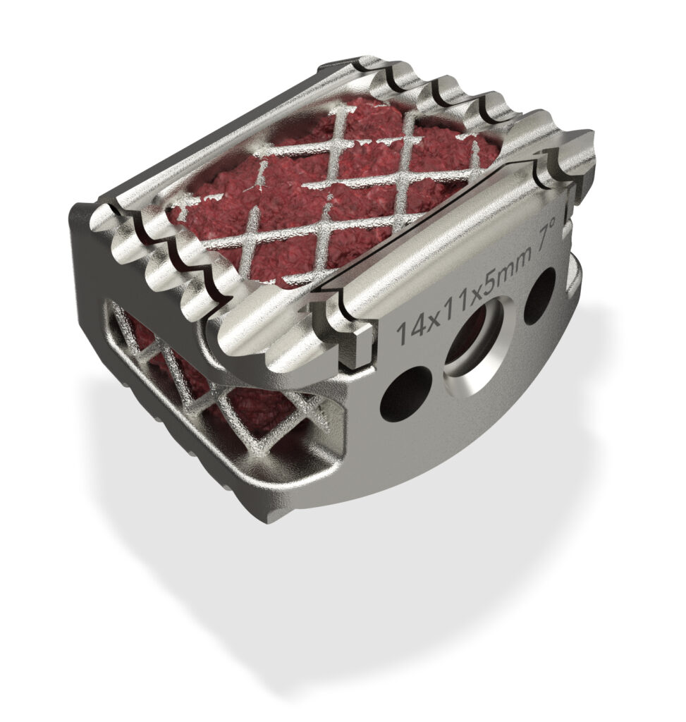 Cervical Spine fixation and interbody