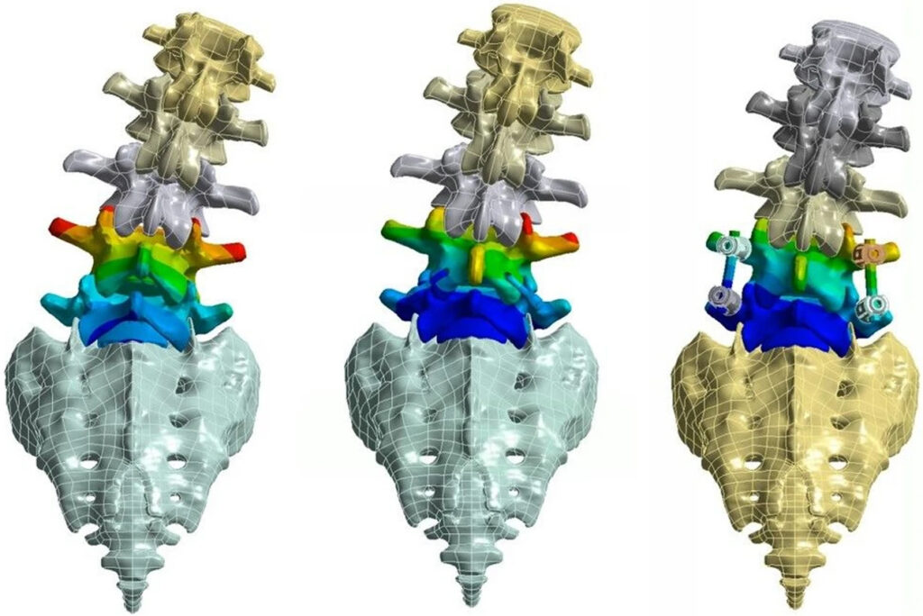 Newsroom - Spinal Elements