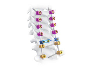 Cervical Spine fixation and interbody